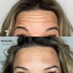 Botox en la Frente: Información, Precio Y Casos Antes y Después