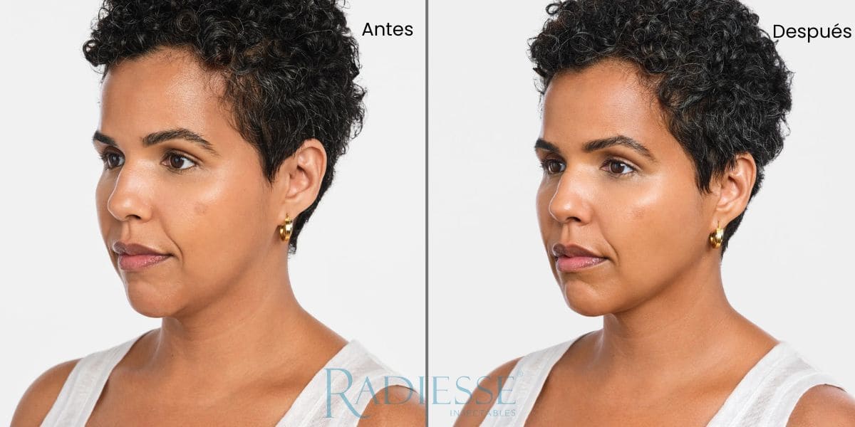 Tratamiento de Radiesse en Zaragoza | Rejuvenece tu rostro sin...